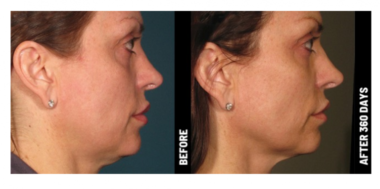 Ultherapy: Does It Work? | BG Medical Aesthetics