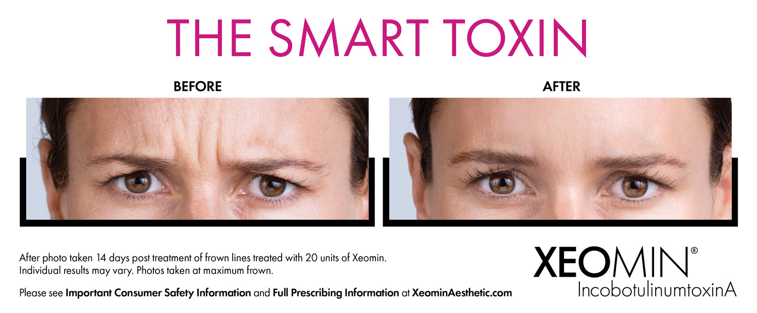 What Is Xeomin? | Anti-Aging Solution | BG Medical Aesthetics