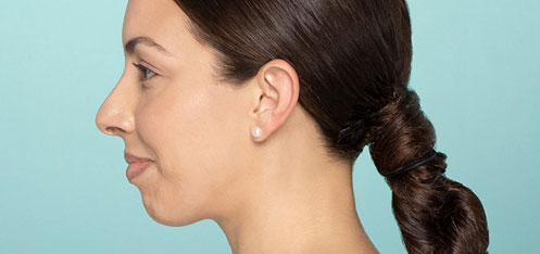Restylane: Under Eyes, Fillers, Lips, Cost, Side Effects