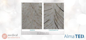 Alma TED » BG Medical Aesthetics