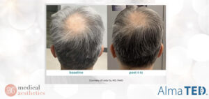 Alma TED » BG Medical Aesthetics