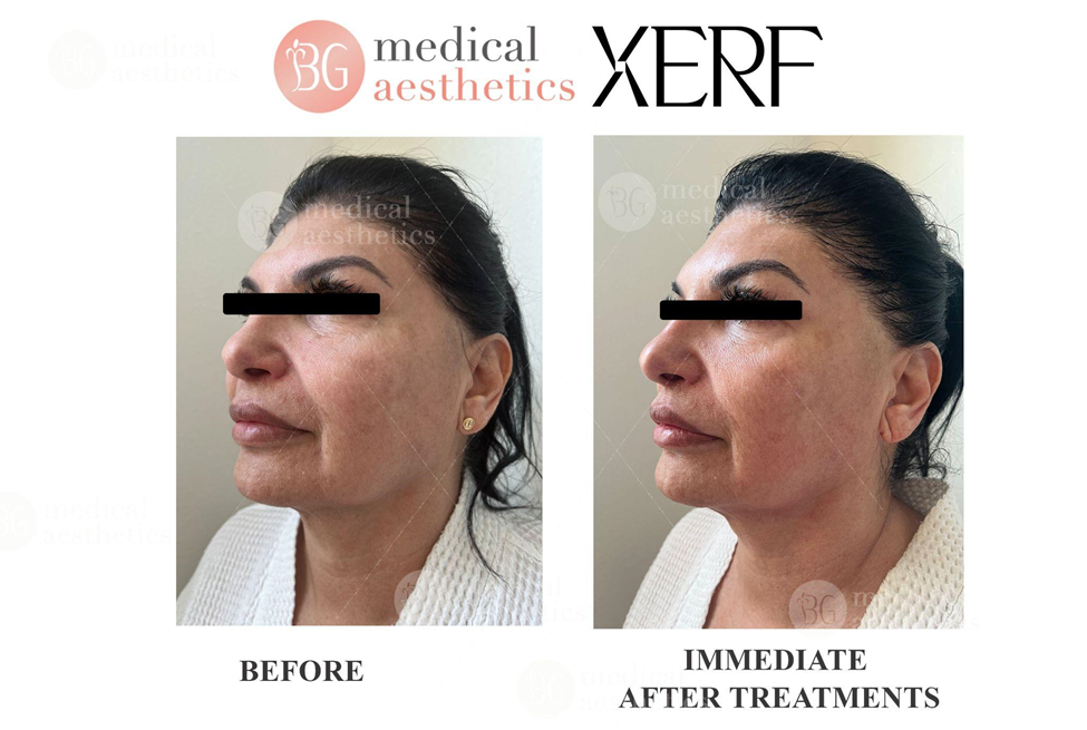 XERF in 2026: The Next Evolution of Non-Invasive Skin Tightening » BG ...